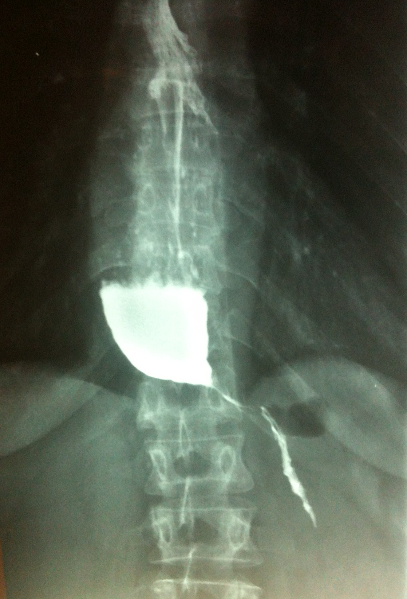 Αχαλασία – esophagus.gr | Μοναδα Χειρουργικης Ανωτερου Πεπτικου