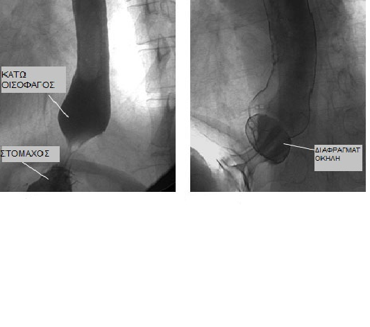 Διαφραγματοκήλη – esophagus.gr | Μοναδα Χειρουργικης Ανωτερου Πεπτικου