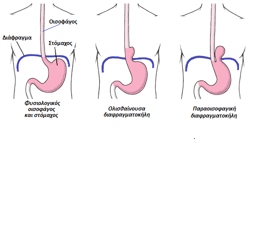 Διαφραγματοκήλη – esophagus.gr | Μοναδα Χειρουργικης Ανωτερου Πεπτικου